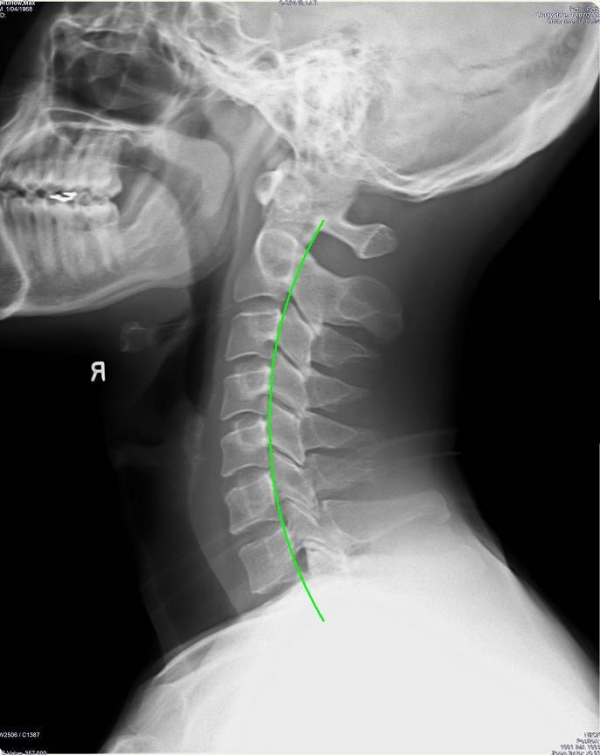 Normal Neck Side view – Healthy Kids & Family Chiropractic Center