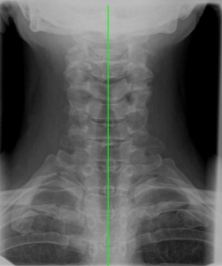 Normal Neck front view – Healthy Kids & Family Chiropractic Center