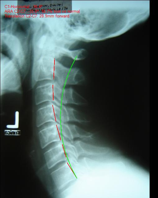 Phase 2 Neck Side View – Healthy Kids & Family Chiropractic Center